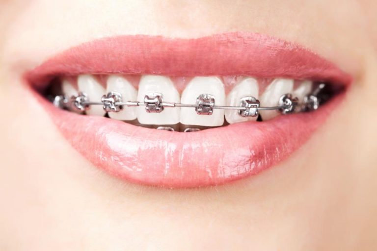 Orthodontist in Jacksonville Beach, FL | Lazzara Orthodontics