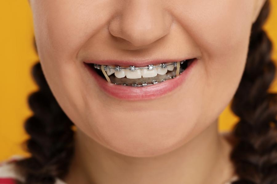 Rubber Bands for Braces: How Do They Work? - Lazzara Orthodontics
